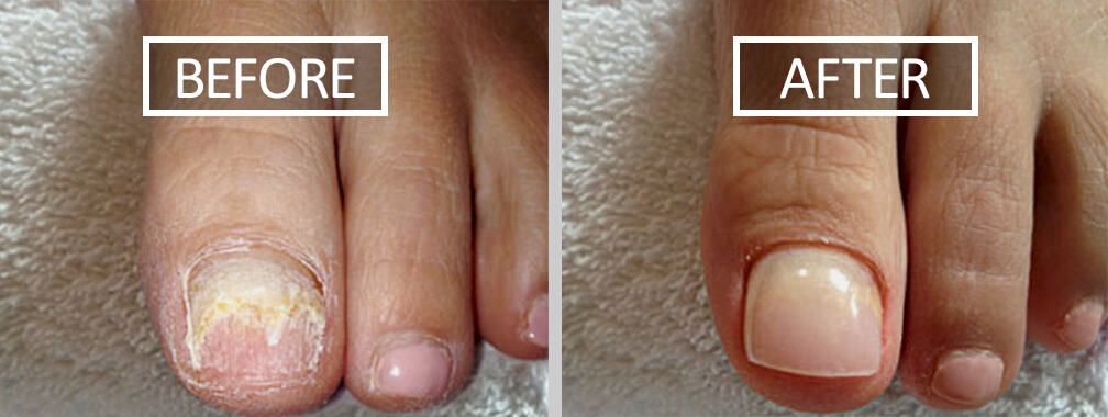 Keryflex Nail Restoration System - Enable Podiatry